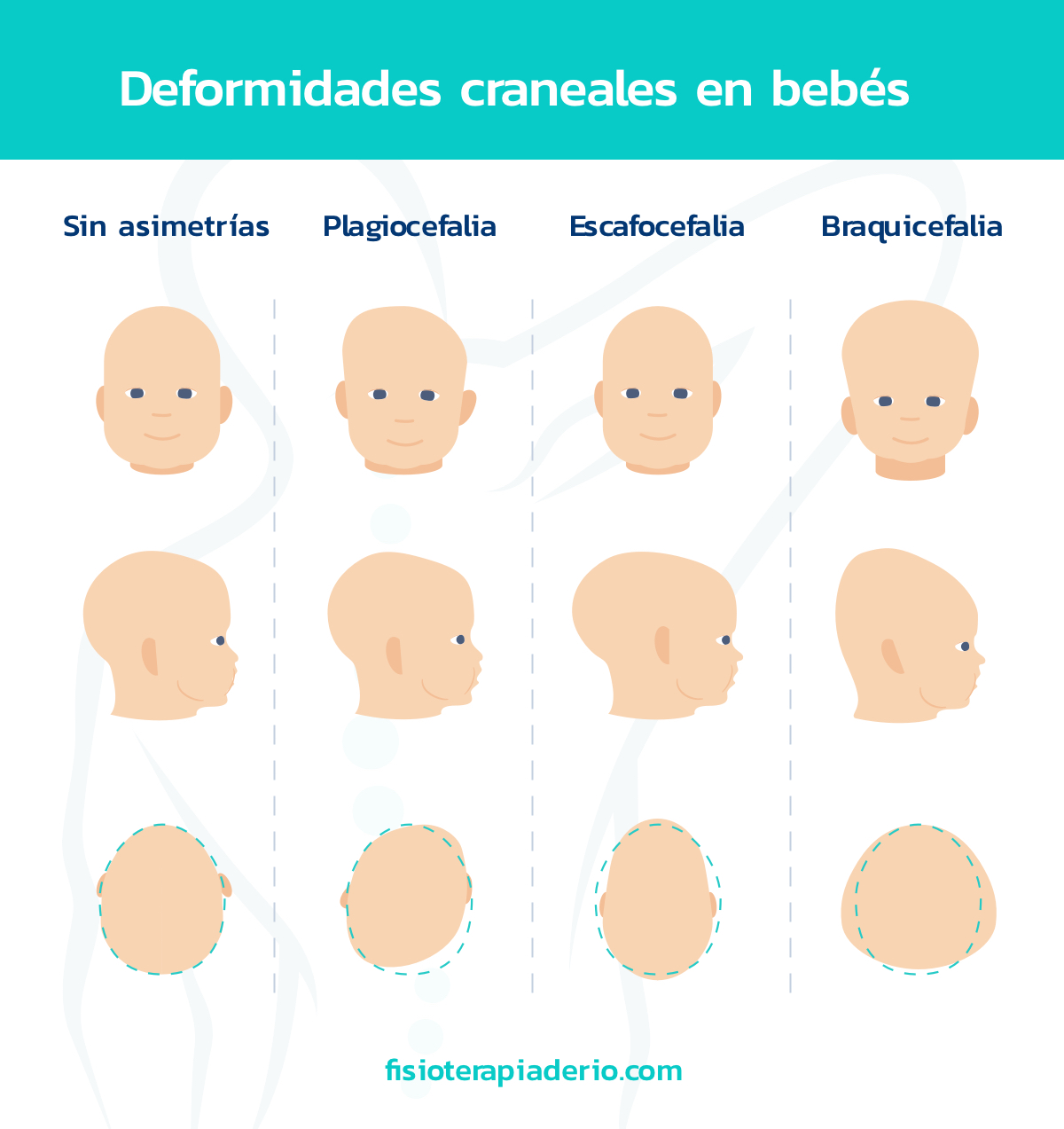 Deformidades Craneales en bebés | Fisioterapia Derio Bilbao